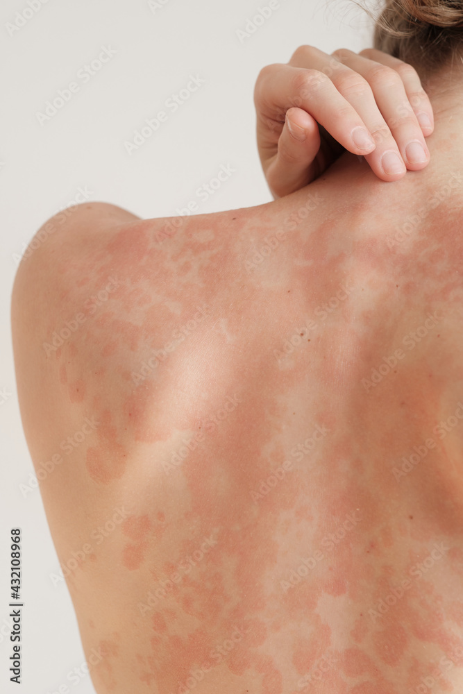 Close-up woman touches herself. Neck, back, spine. Psoriasis skin ...