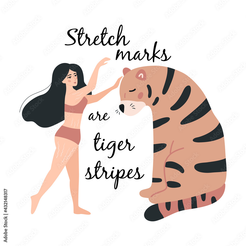 Body positive concept. Young woman with stretch marks on skins. Love ...