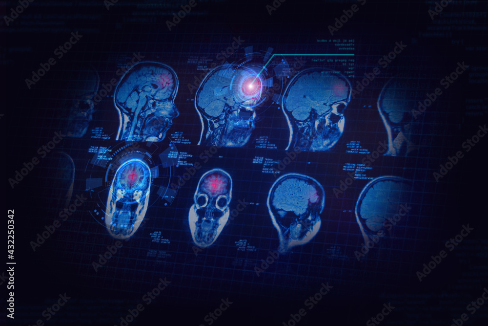 Poster MRI brain scan with dangerous point, artificial intelligence in ...