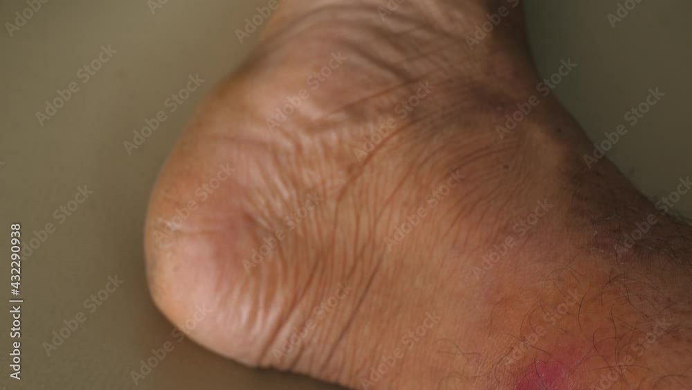 Skin disease, which is caused by allergic ulcers, canker sores or ...