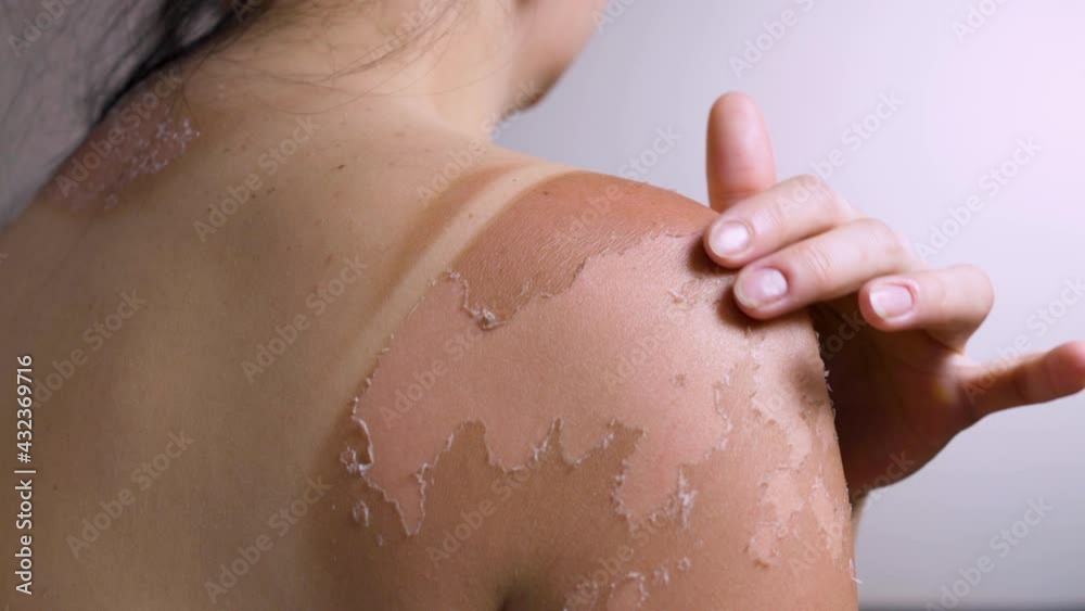 pain, skin, care, sun, summer, burn, shoulder, skin care, tan, burning ...