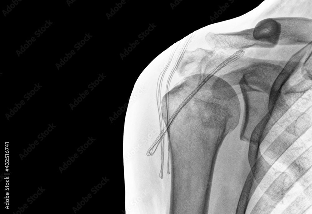 X-ray of a luminous of shoulder isolated on black background. Chronic ...
