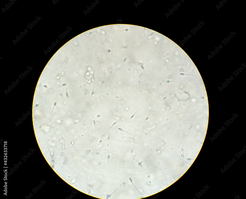 Foto de Semen analysis, sperm analysis on microscopic examination ...