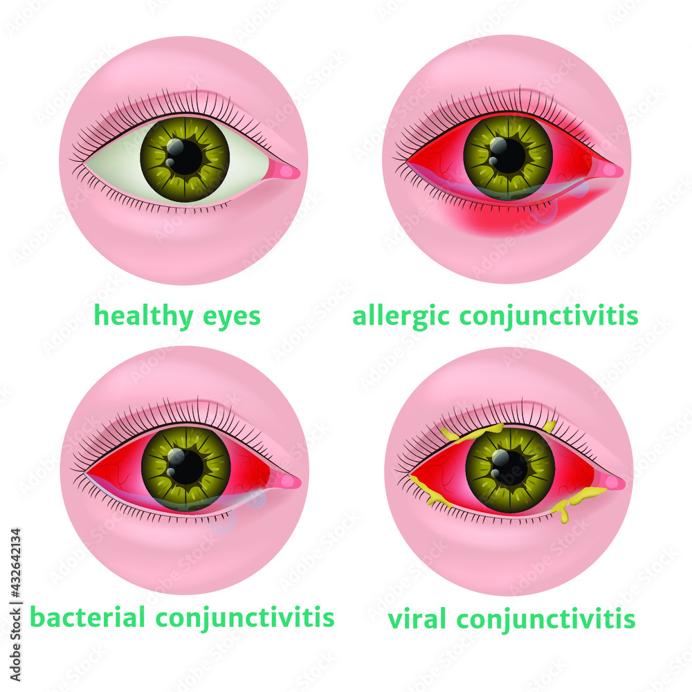 Conjunctivitis. Diseases of the human eye. Viral, bacterial, allergic ...