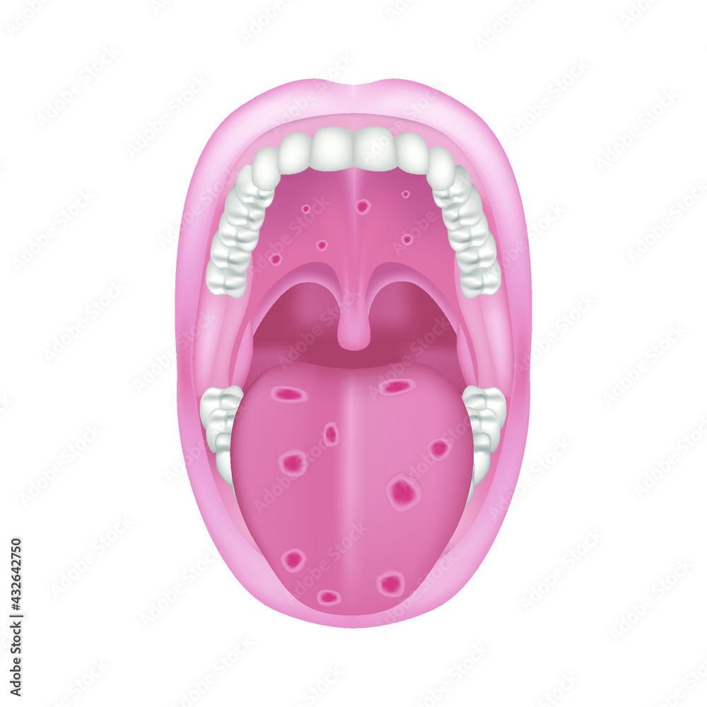 Oral syphilis. Venereal disease. Ulcers on the tongue and palate ...