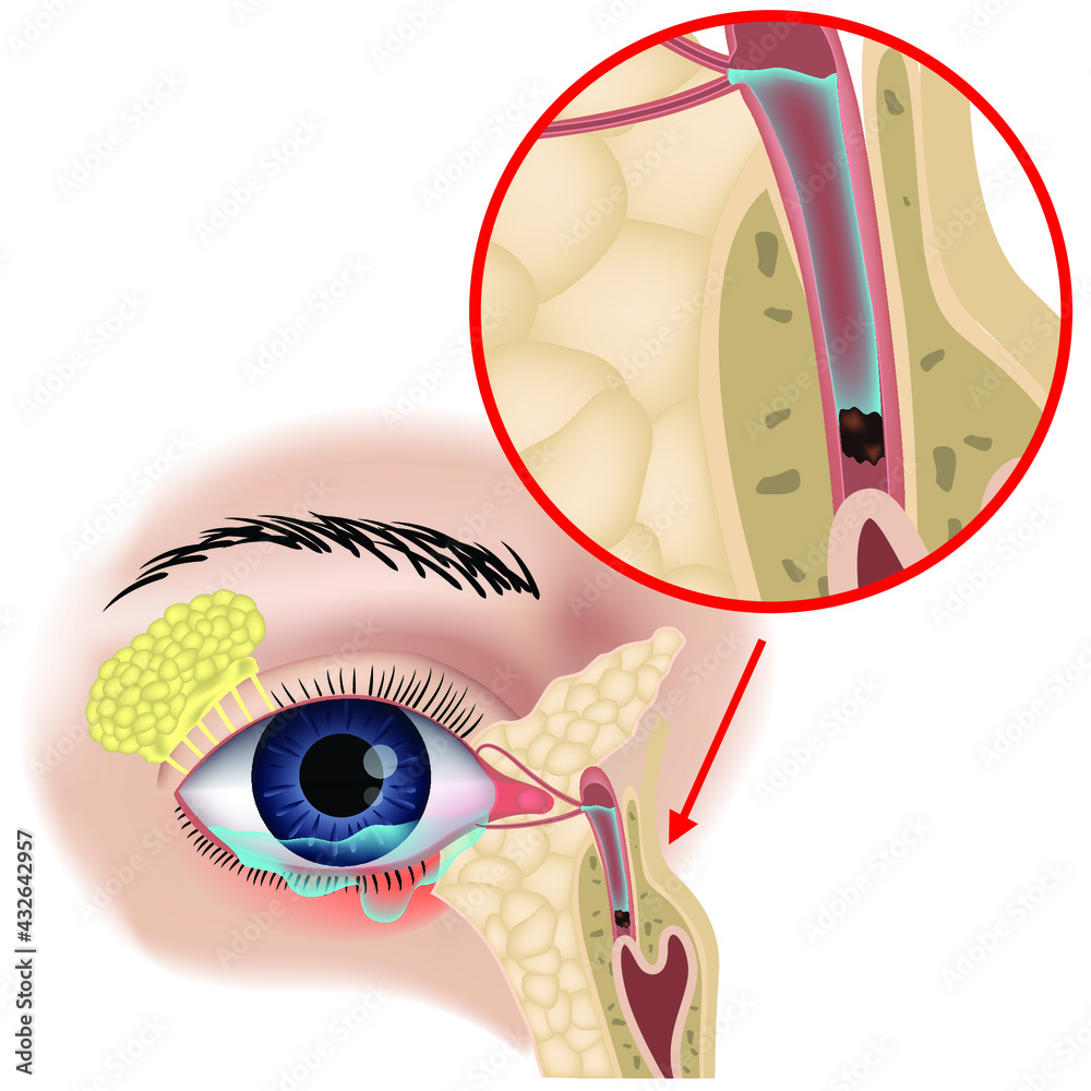 Blockage of the lacrimal canals. Dacryocystitis. Anatomy of the eye ...