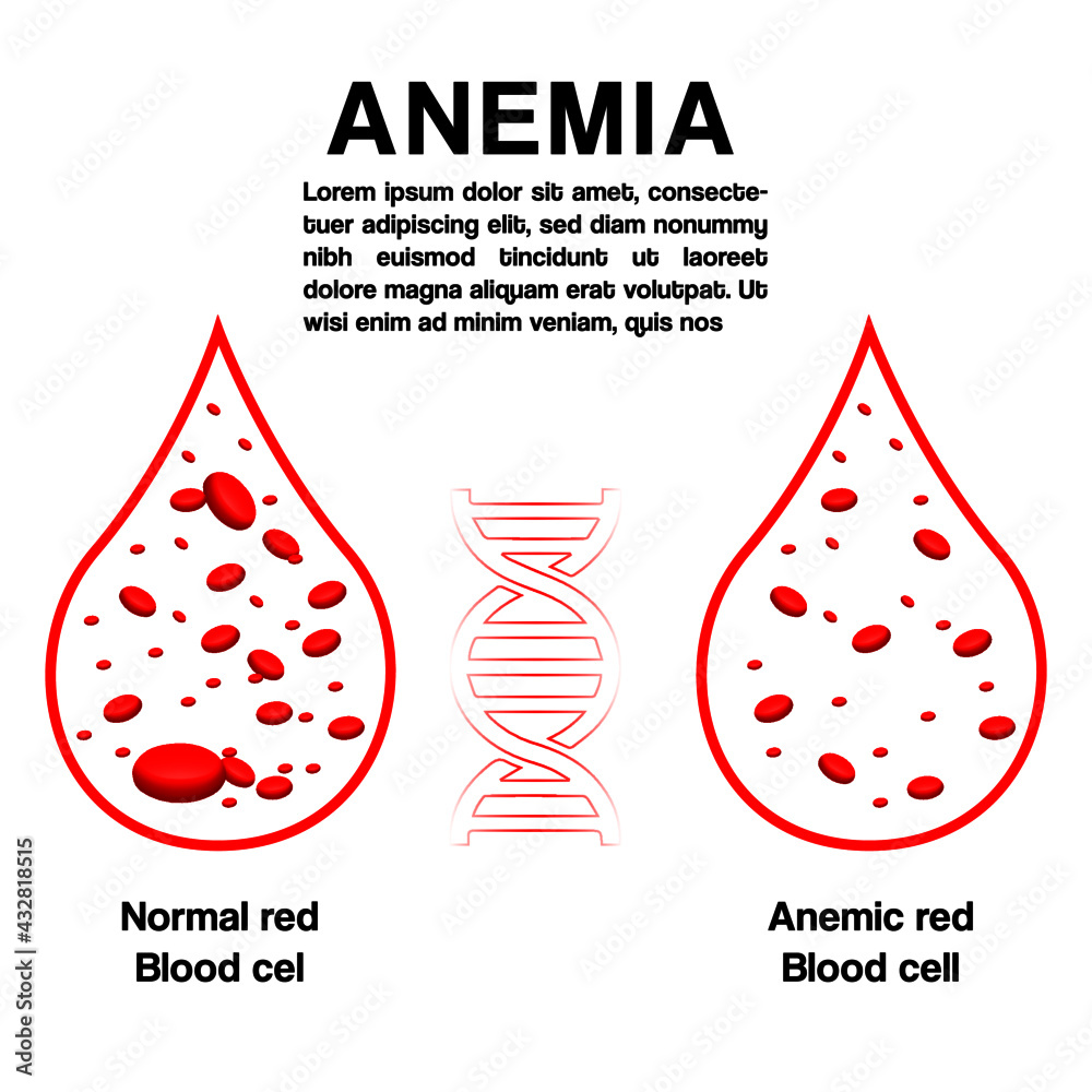 Infographic image of anemia. The difference between the number of red ...