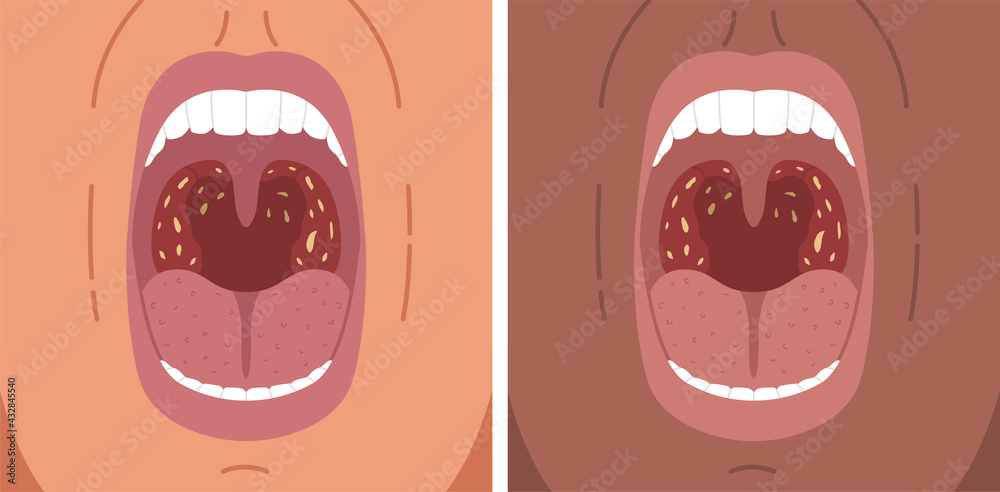 Vector illustration of bacterial tonsillitis, sore throat, tonsil ...