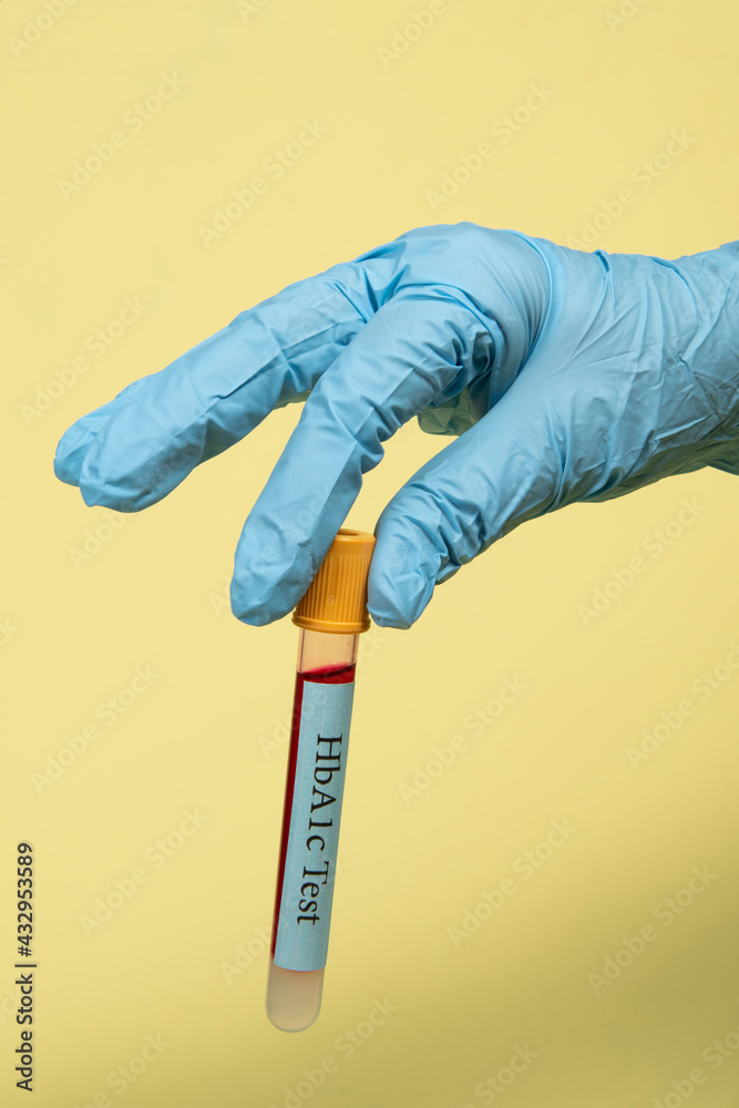 hand with rubber glove holding vacuum tube of blood to do HbA1c ...