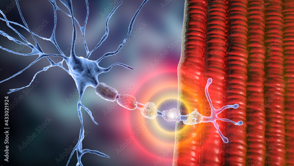 Demyelination of a neuron, the damage of the neuron myelin sheath seen ...