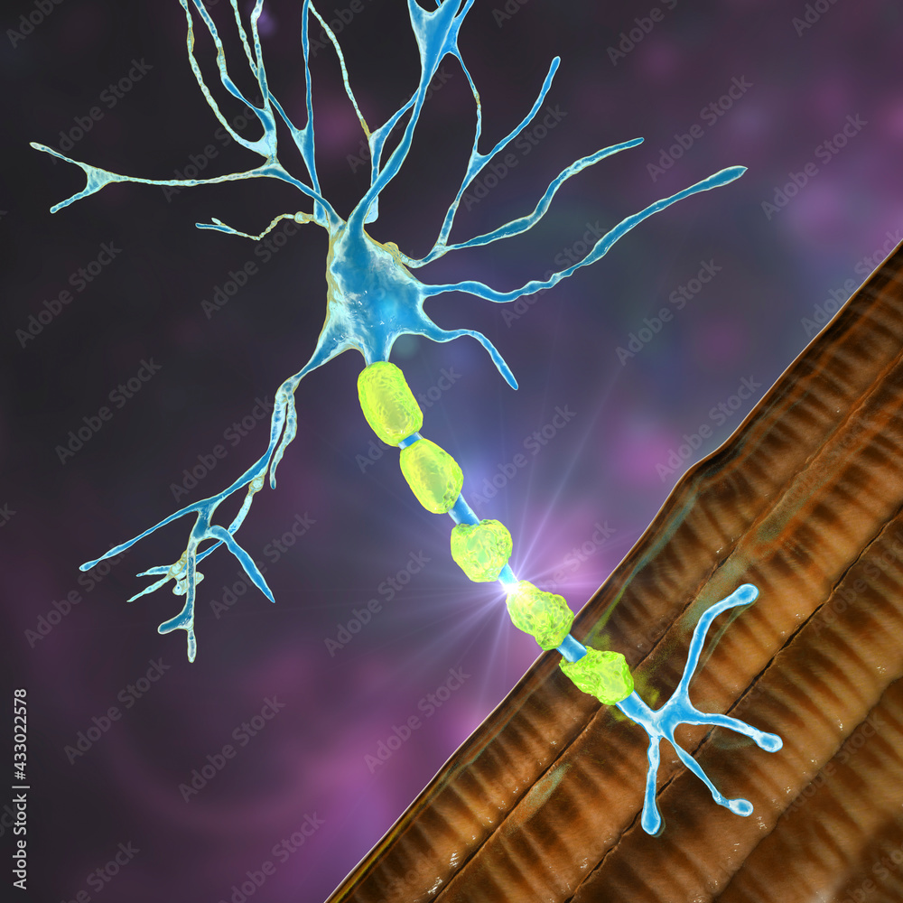 Demyelination of a neuron, the damage of the neuron myelin sheath seen ...