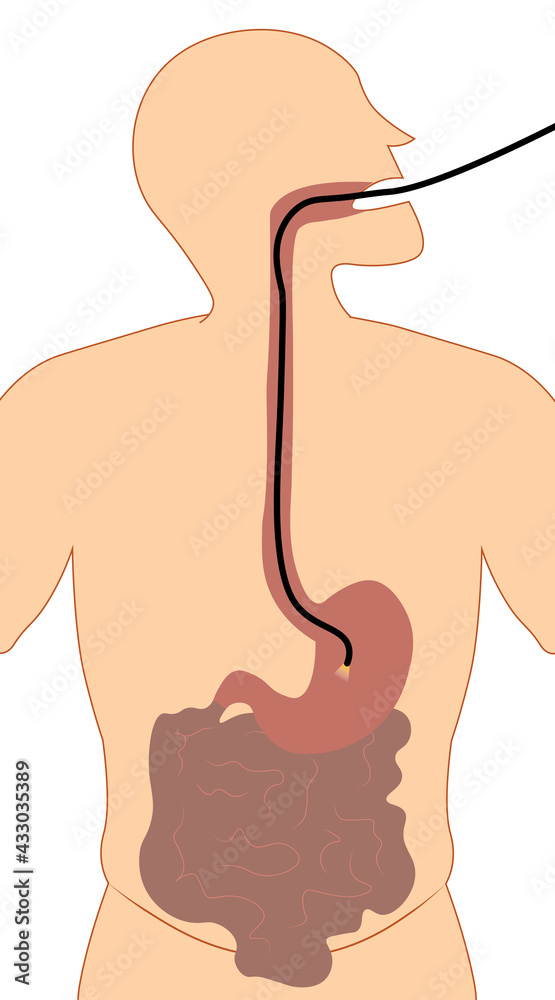 Upper endoscopy. Digestive system Illustration. GI tract. Mouth ...