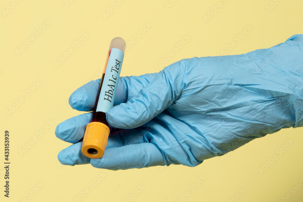 hand with rubber glove holding vacuum tube of blood to do HbA1c ...