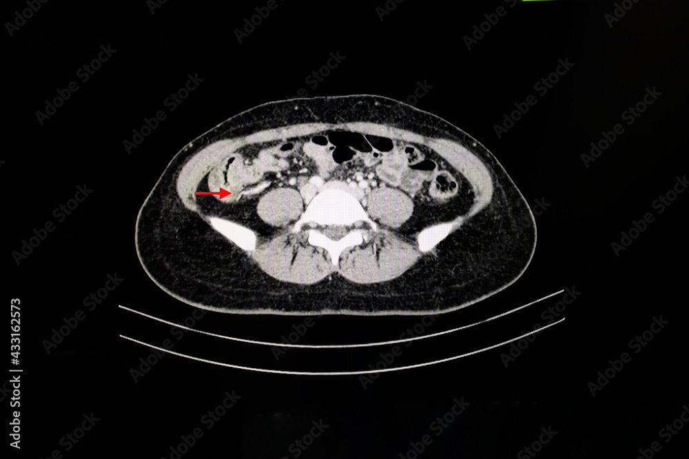 CT Scan of an abdomen suggesting the diagnosis of acute appendicitis ...