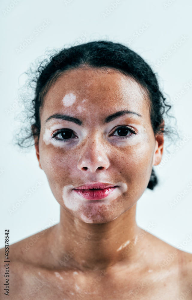 Beautiful woman with vitiligo skin posing in studio. Concept about body ...