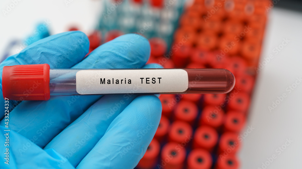 Malaria parasite test result with blood sample in test tube on doctor ...
