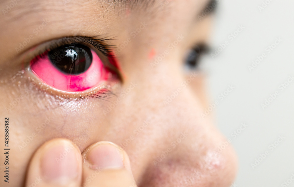 Asian lady woman with conjunctivitis is checking for her pink eye,girl ...