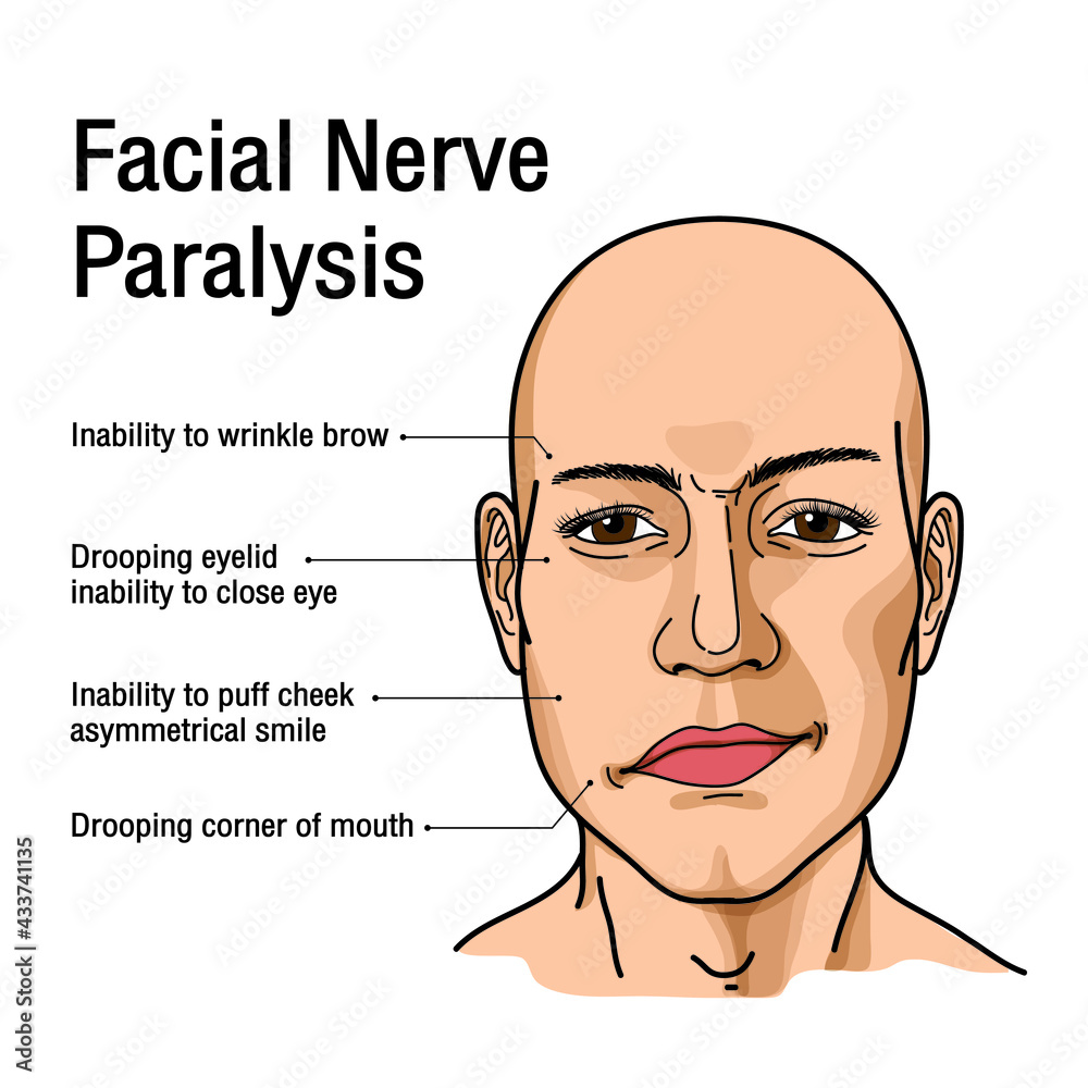 Paralysis of the facial nerve. Bell's palsy. Vector Stock Vector ...