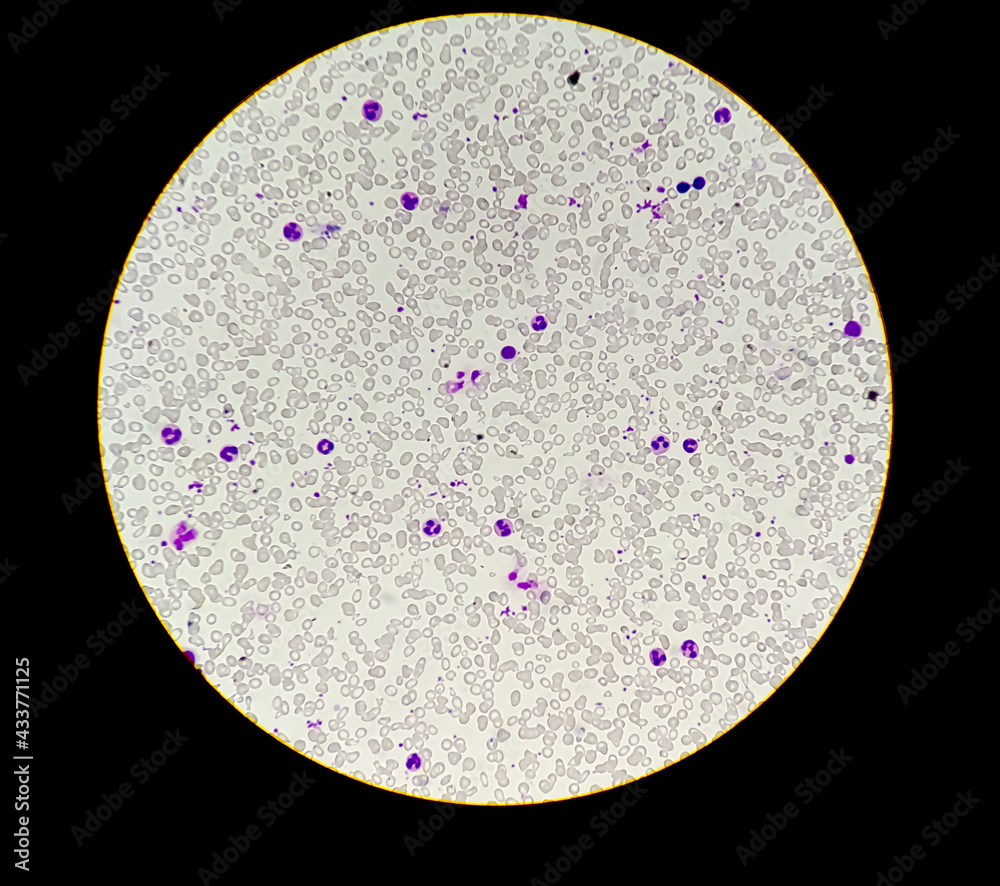 Microscopic view of hematology stained slide. close view. Hematology ...