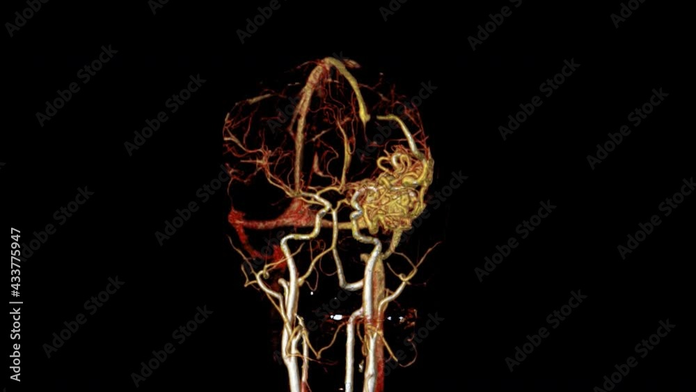 CTA Brain or computed tomography angiography of the brain 3D rendering ...