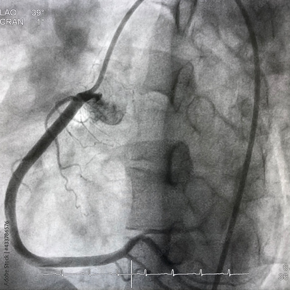 Normal coronary angiogram of right coronary artery (RCA) during cardiac ...