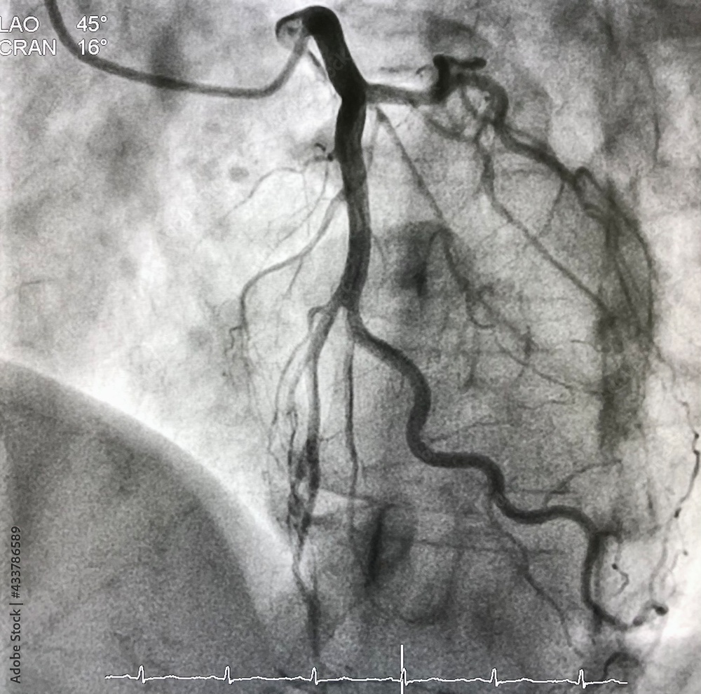 Normal coronary angiogram of left coronary artery during cardiac ...