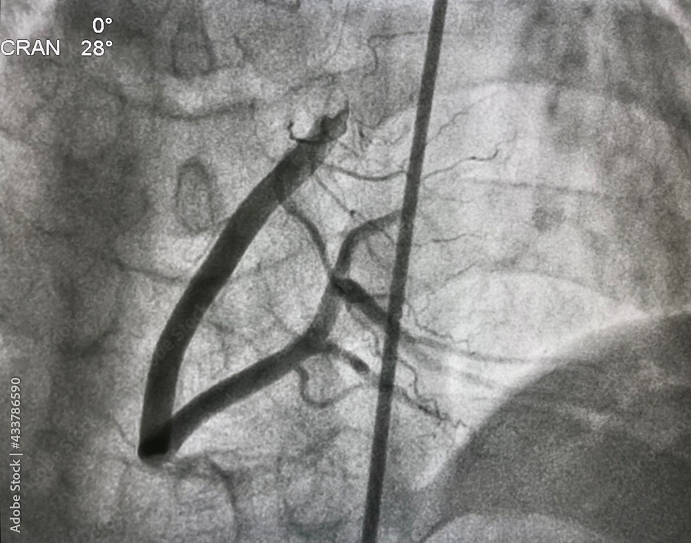 Normal coronary angiogram of right coronary artery (RCA) during cardiac ...