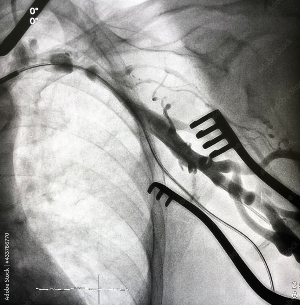 X ray image during permanent pacemaker implantation procedure. Stock ...