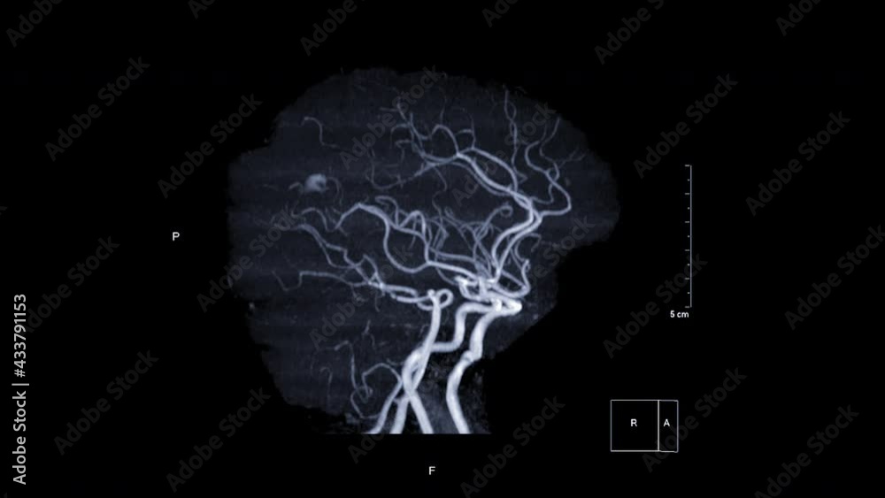 MRA Brain or Magnetic resonance angiography of Cerebral artery in the ...