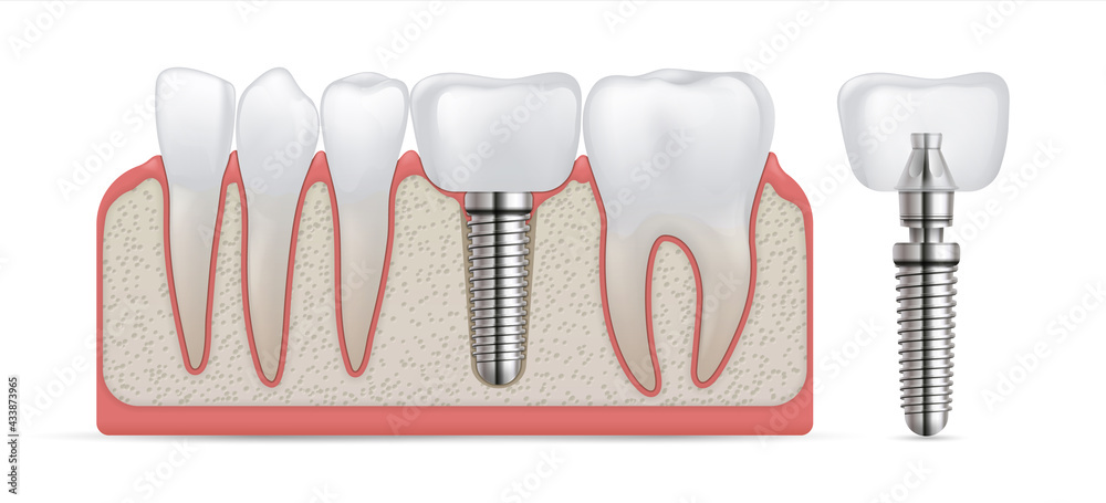 Dental implant. Teeth care surgery and crown fixture. Tooth replacement ...