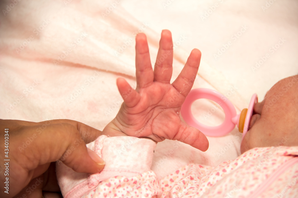 Newborn Baby Girl with pacifier with an unhealthy rash in her open palm ...
