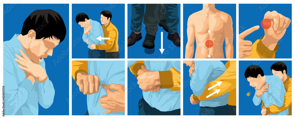 Heimlich maneuver vector illustration. first aid to choking for adults ...