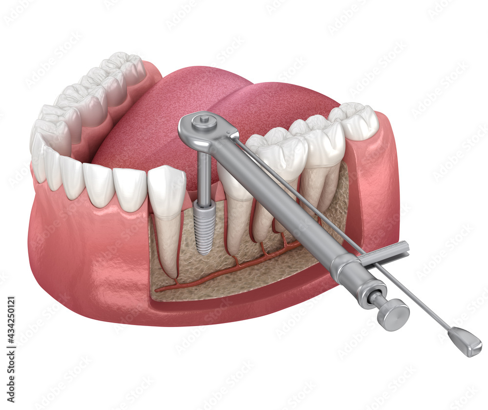 Dental torque wrench makes implant fixation in to the bone. Medically ...