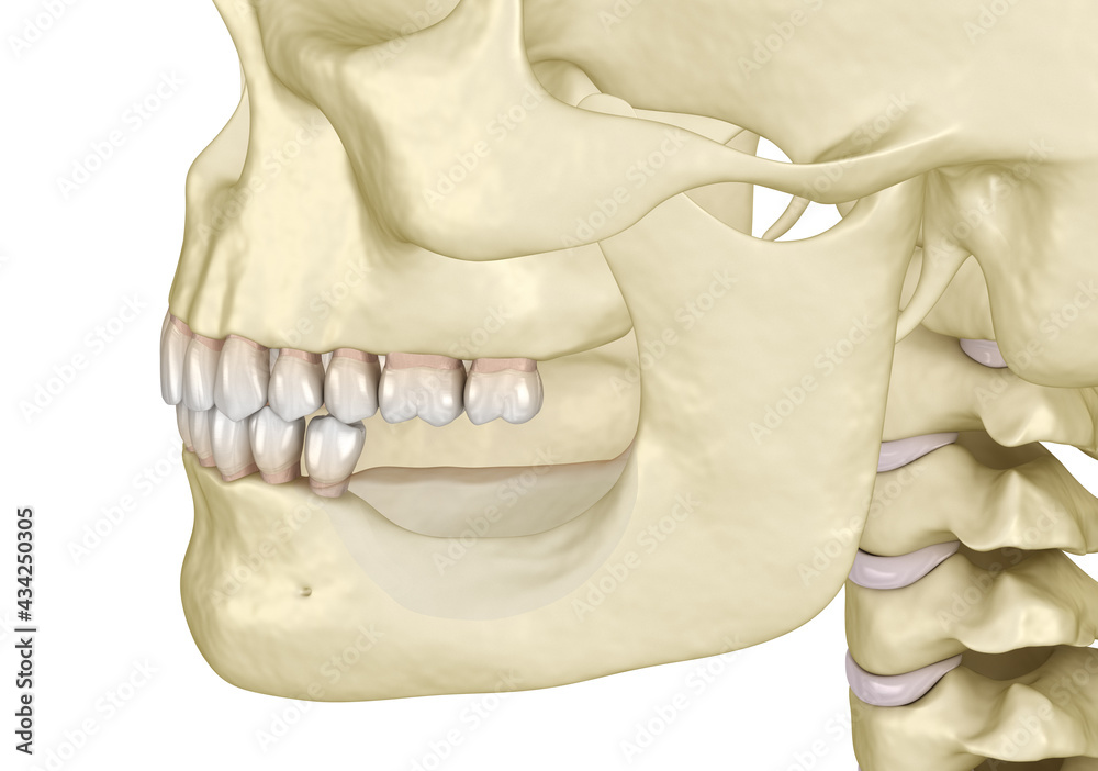 Mandibular Jaw, bone recession after losing molars teeth. Medically ...