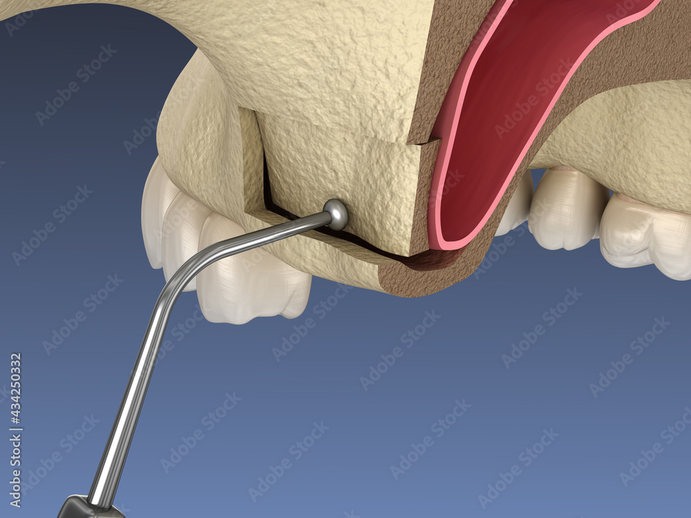 Sinus Lift Surgery - Moving sinus membrane. 3D illustration Stock ...