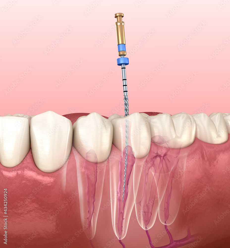 Endodontic root canal treatment process. Medically accurate tooth 3D ...