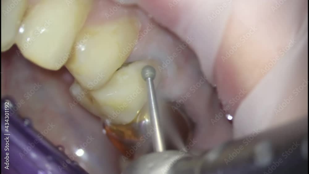 dentistry. shooting with a microscope. necrectomy. the dentist removes ...