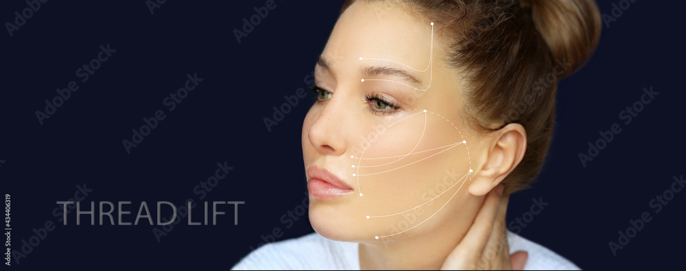 thread lift procedure ,non-surgical facelift,markup Stock Photo | Adobe ...