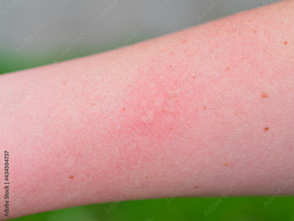 Hand with dermatitis red itchy swollen skin after touching nettle ...