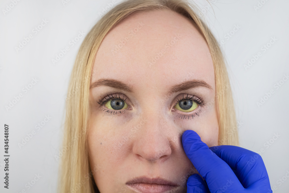 The yellow color of the woman eye. Symptom of jaundice, hepatitis or ...