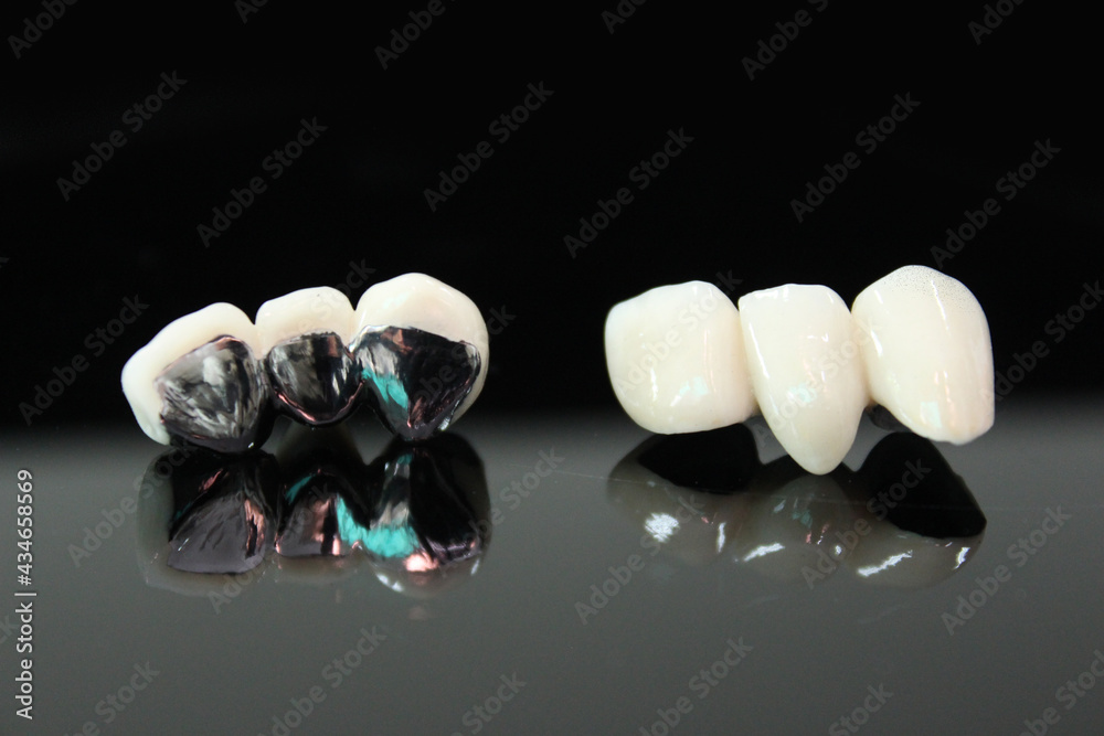 Porcelain fused to metal. PFM bridge Stock 写真 | Adobe Stock