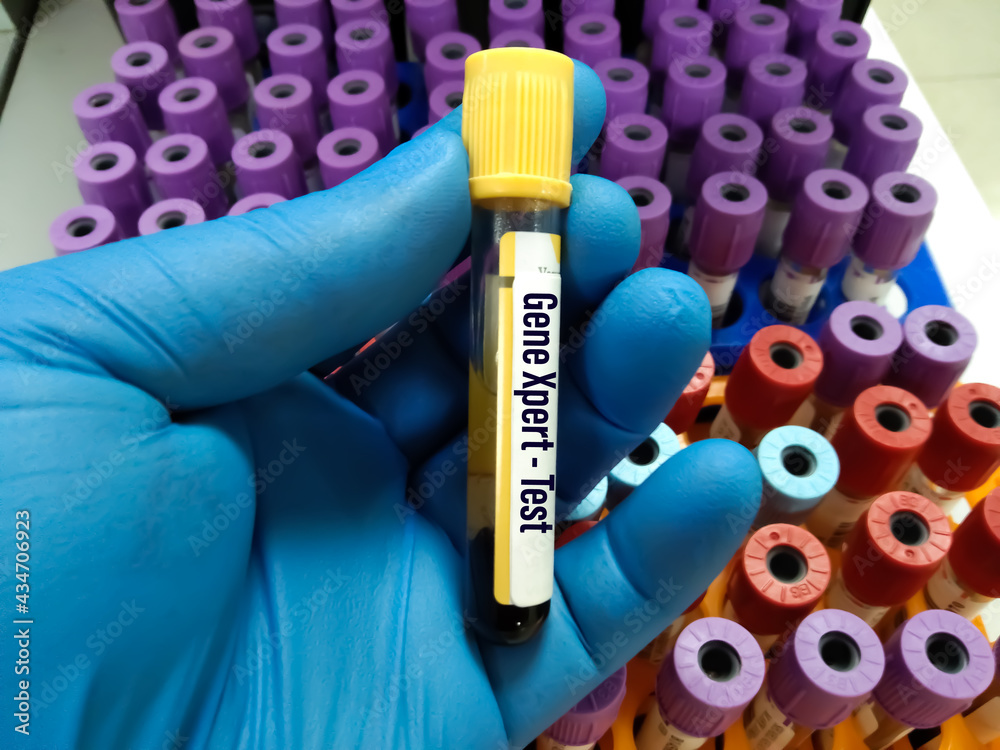 Blood sample Tube holding by doctor for Gene Xpert test. A molecular ...