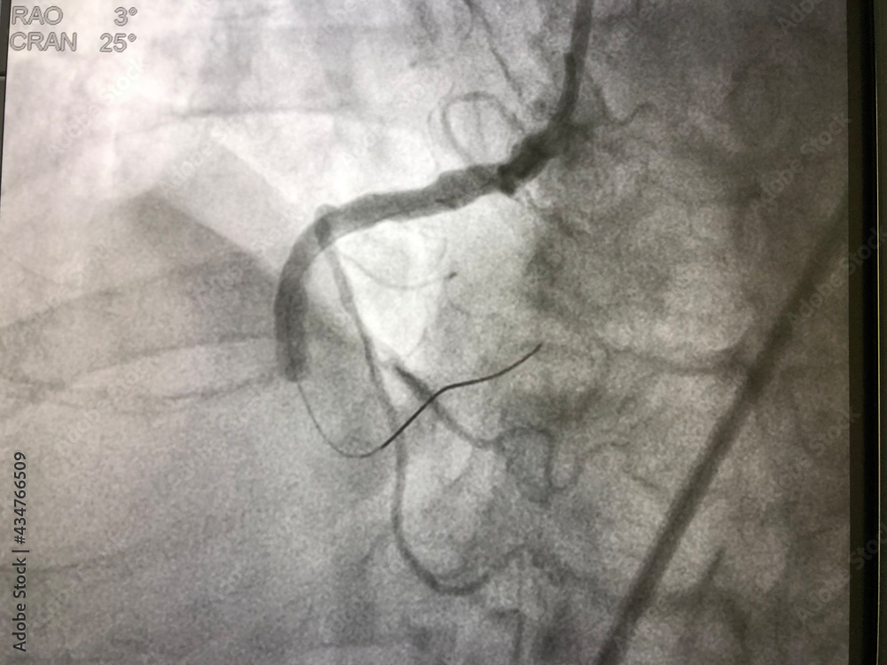Foto de coronary angiogram shown massive thrombus that occluded right ...