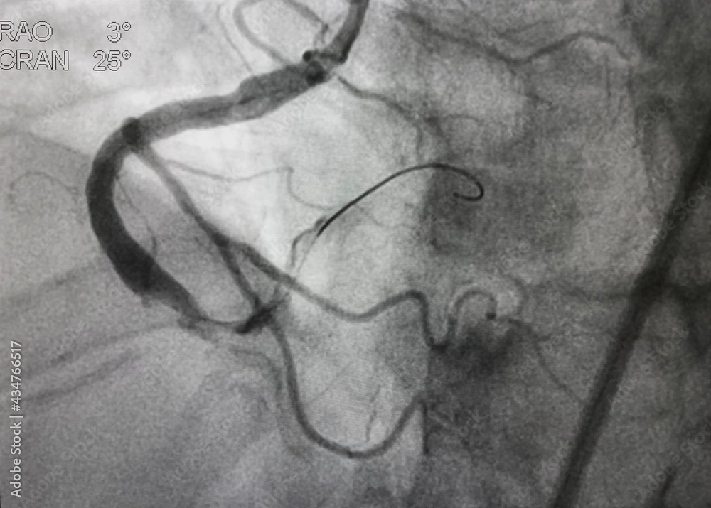 coronary angiogram shown massive thrombus that occluded right coronary ...