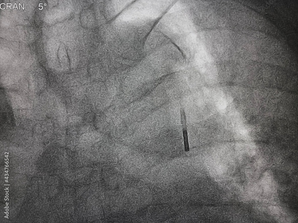 X ray imaging of intra aortic balloon pump (IABP) machine during ...