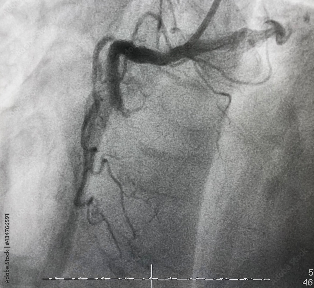 coronary angiogram shown massive thrombus that occluded right coronary ...