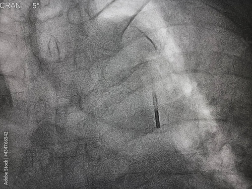 X ray imaging of intra aortic balloon pump (IABP) machine during ...