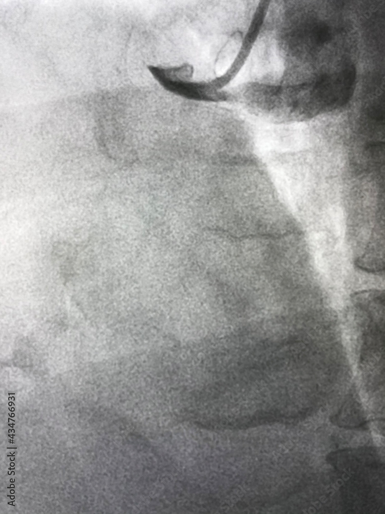 coronary angiogram shown massive thrombus that occluded right coronary ...