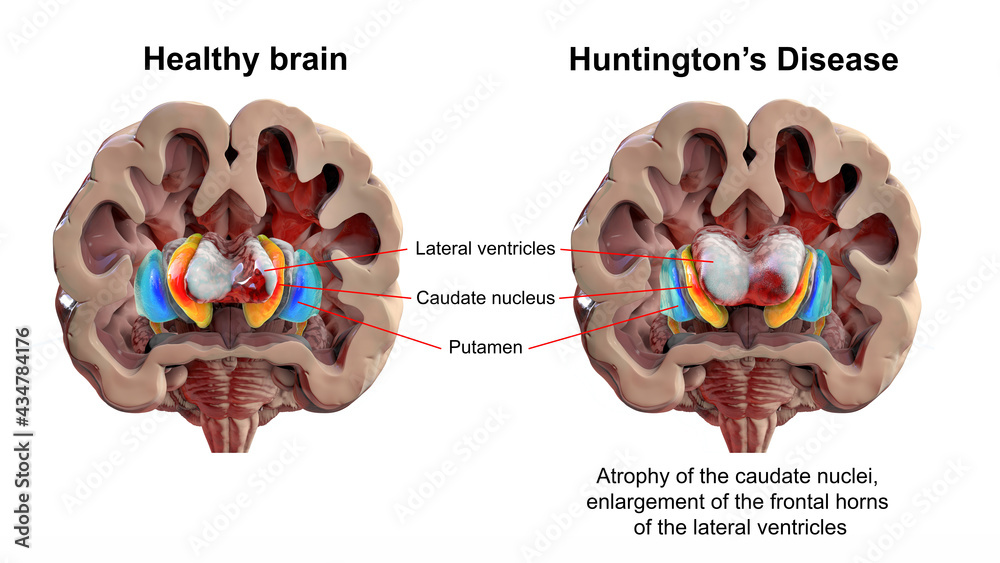 Dorsal striatum and lateral ventricles in healthy brain and in ...