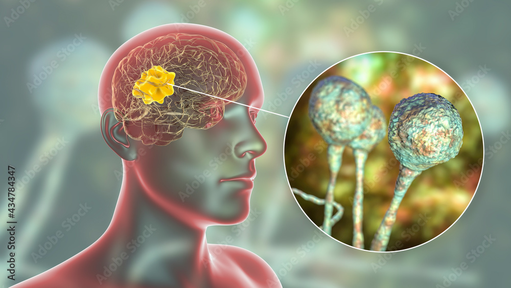 Brain mucormycosis, a brain lesion caused by fungi Mucor Stock ...